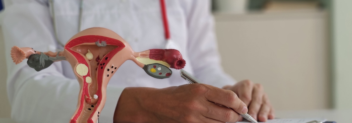 UFE for Different Types of Fibroids: Ideal Candidates - Minima