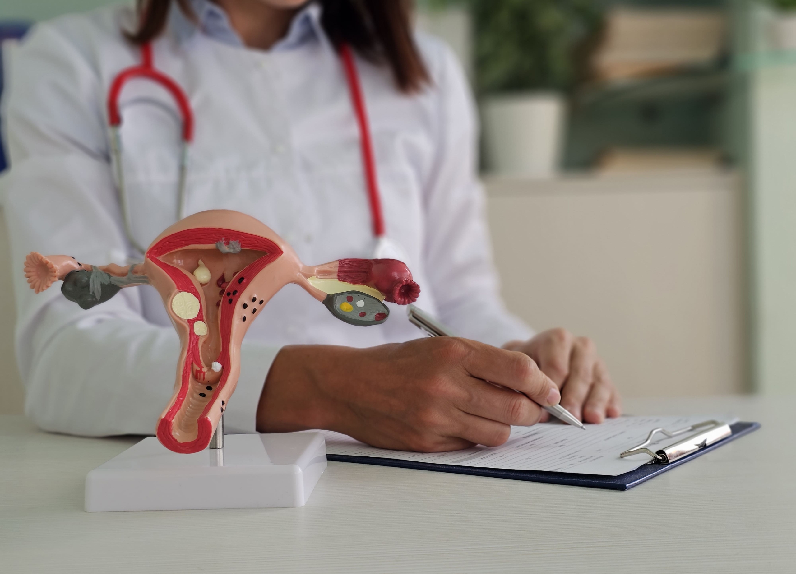 UFE for Different Types of Fibroids: Ideal Candidates - Minima